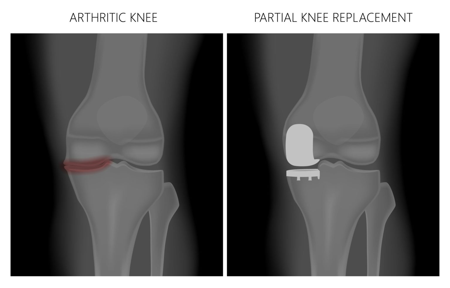 Partial Knee Replacement: A Precise Solution for Targeted Relief